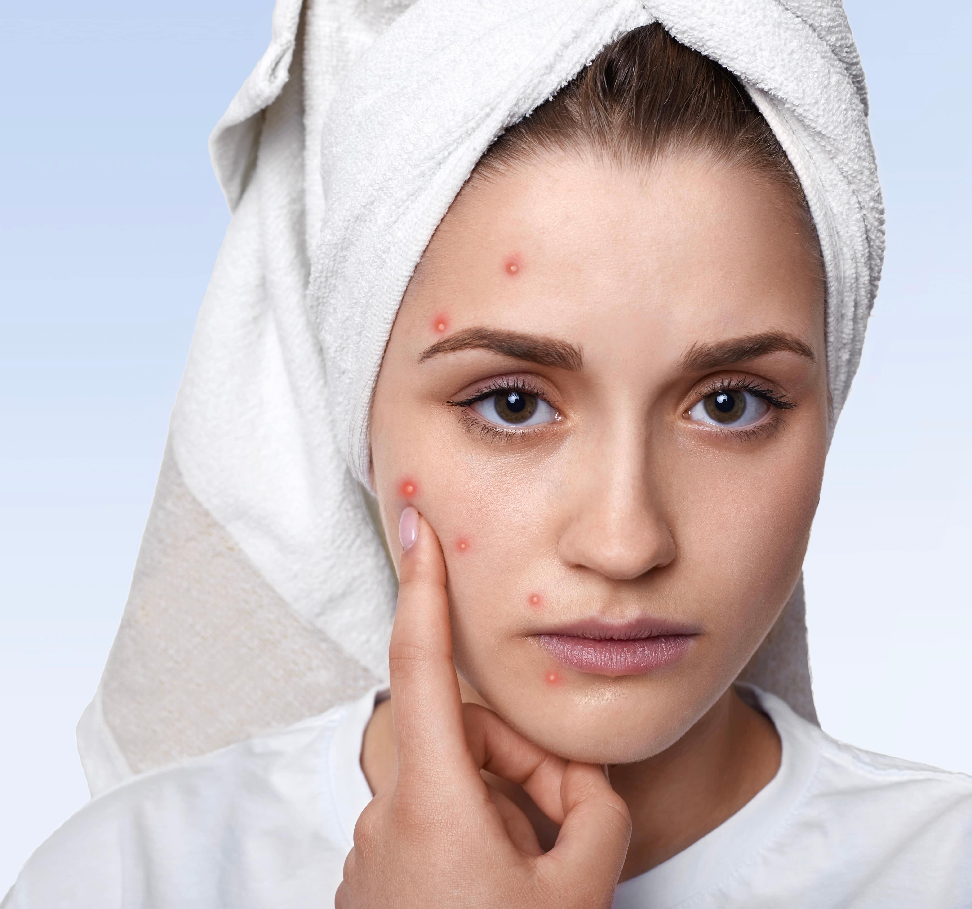 Acne & Pimples – Organicos India Store